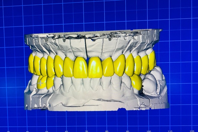 Crown & Bridge - CadCam Masters