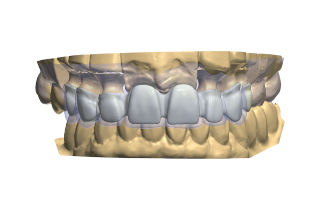 Cutback anterior bridge design for labial layering - CadCam Masters