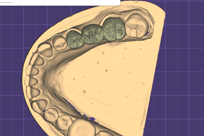 posterior bridge - CadCam Masters