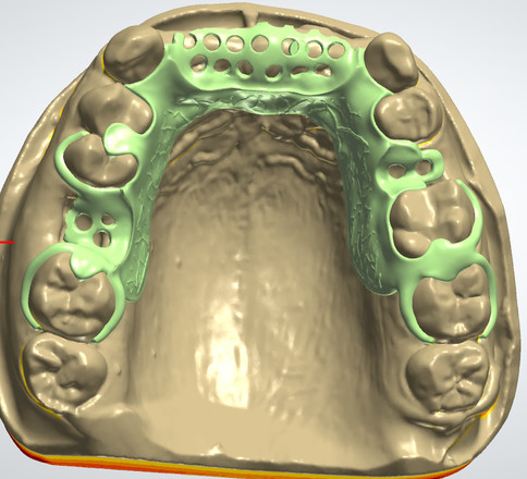 Partial Denture Framework 3shape Cad Design for Print - CadCam Masters