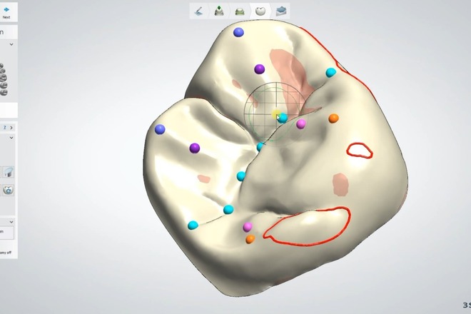 Crown & Bridge Cad Design - CadCam Masters