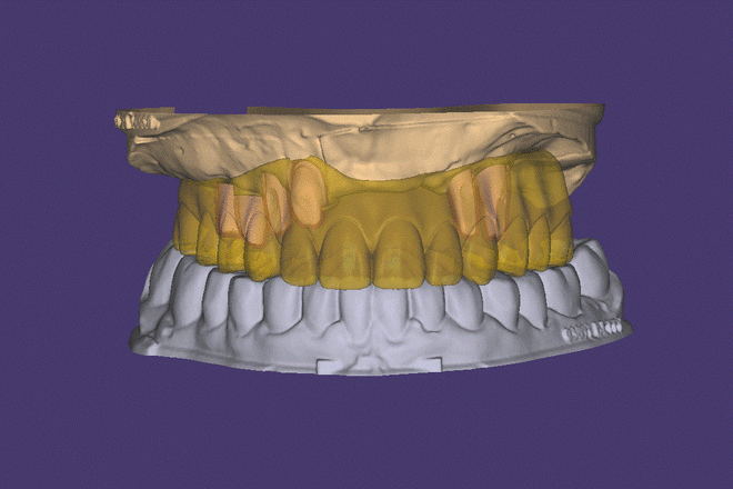 All on X and metal coping bridge - CadCam Masters