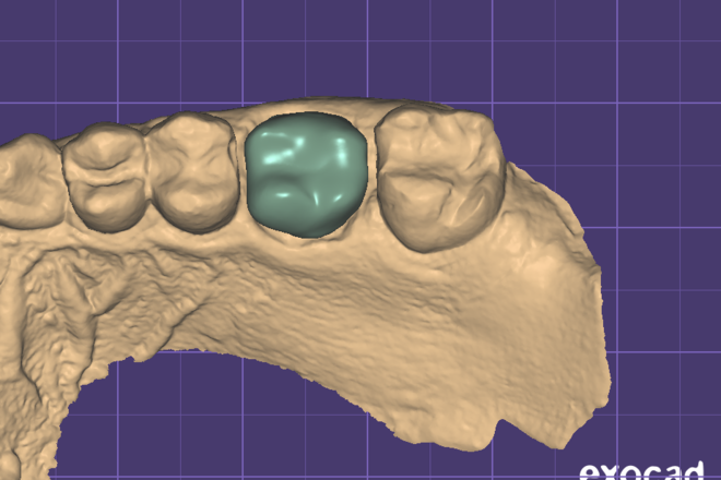 Offset crown - CadCam Masters