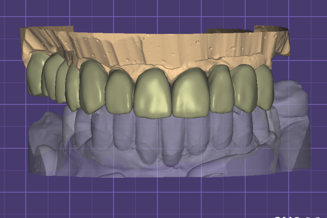 crown and bridge - CadCam Masters
