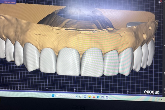 Facetas/Pôntico Anatômico/Enceramento - CadCam Masters