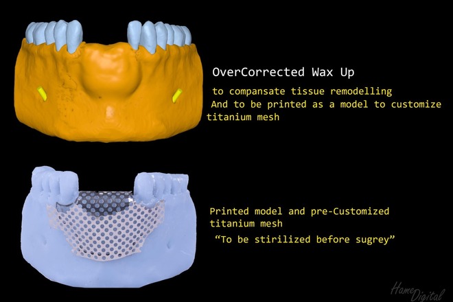 Bone Augmentation Surgical Planning + Guide - CadCam Masters