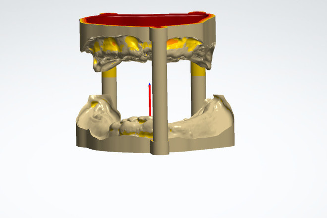 C&B Model - Denture Model – RPD Model – Ortho Model – CAD Design ...