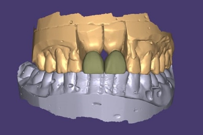 Crown and bridge - CadCam Masters