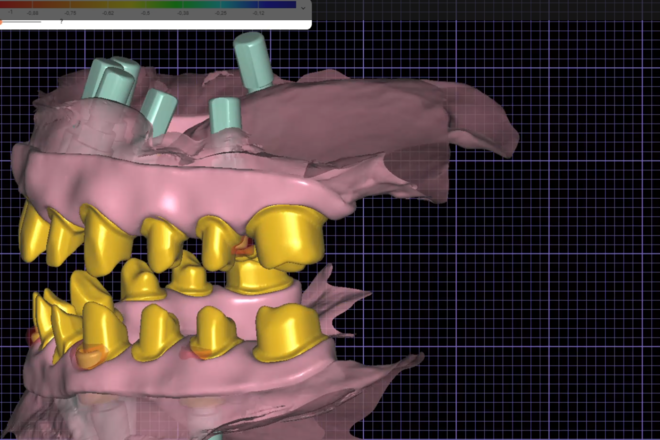 implant bridge design - CadCam Masters