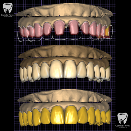 crowns design - CadCam Masters