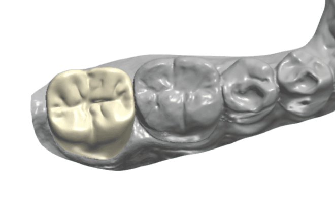 Crown and bridge design - CadCam Masters