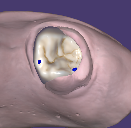 Onlays & Inlays Design - CadCam Masters