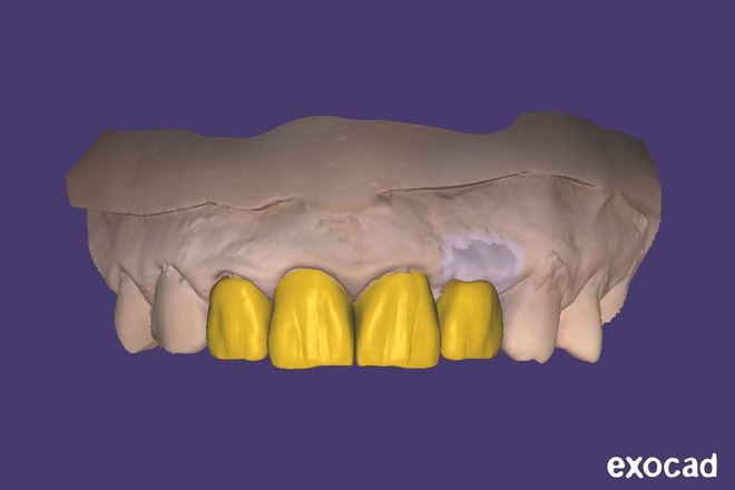 Crowns & Bridges Design - CadCam Masters