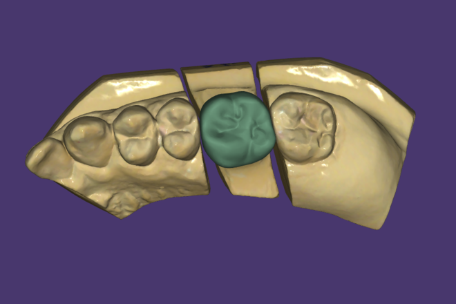 Full Coverage Crown - CadCam Masters