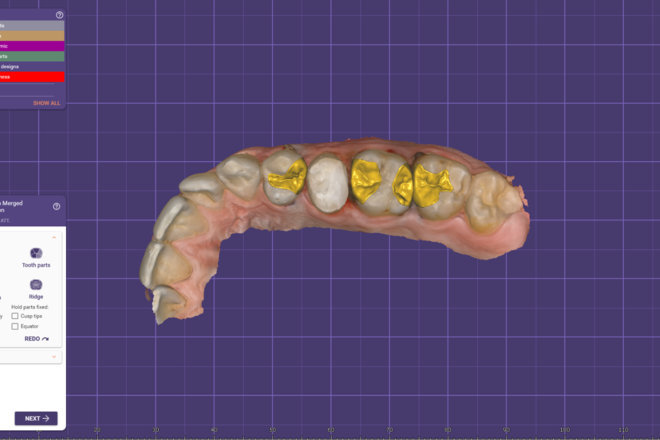 Inlays, Onlays & Endocrowns - CadCam Masters