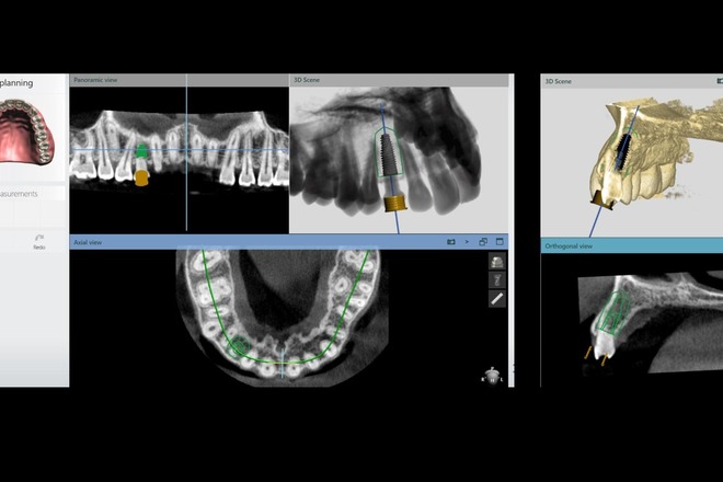 Surgical Guide (Partially Edentulous) - CadCam Masters