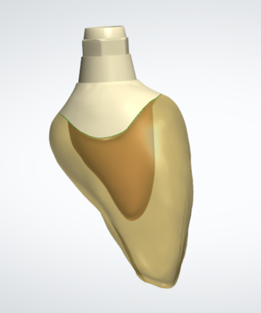 Custom Abutments! - CadCam Masters