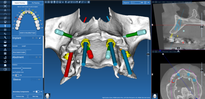 I will plan and make a full arch surgical guide - CadCam Masters