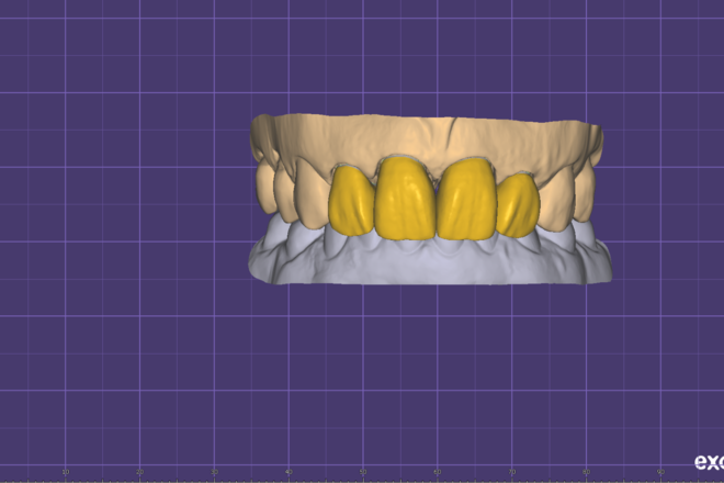 Crown and Bridges -Full contour , Simple Coping or cut back - CadCam ...