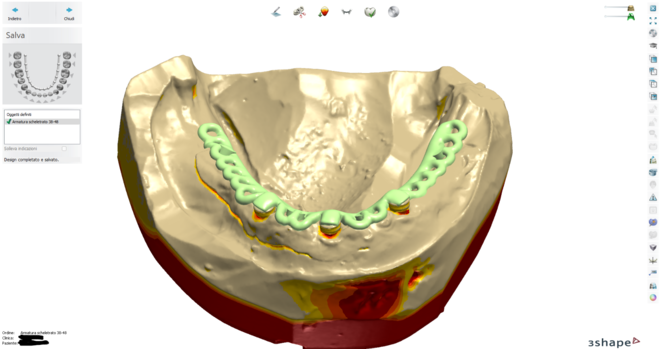 prosthesis reinforcement - CadCam Masters