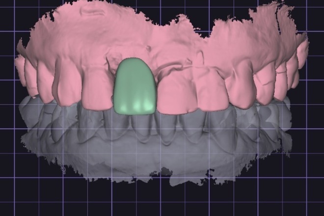 Implant Bridge and Crown - CadCam Masters