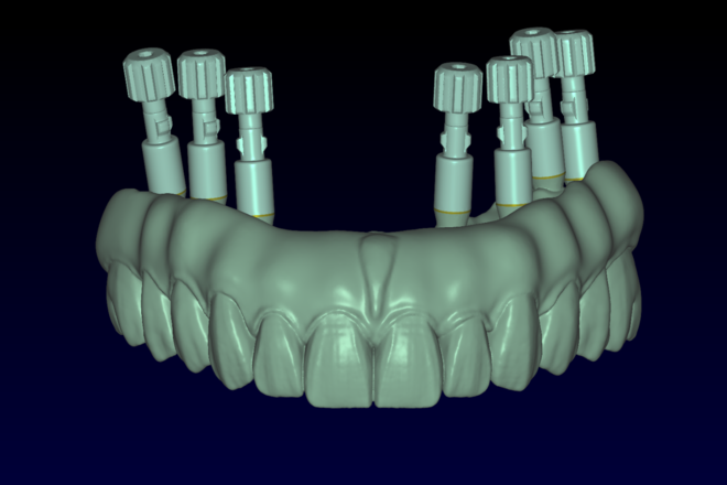 Implant Crown & Bridge/All-on-X - CadCam Masters