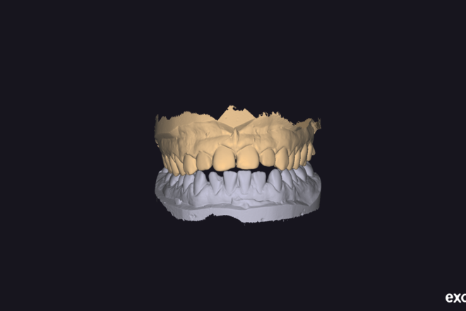 Mock Up (Upper/Lower) - CadCam Masters