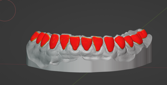 Bleaching Tray models - CadCam Masters