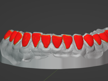 Bleaching Tray models - CadCam Masters