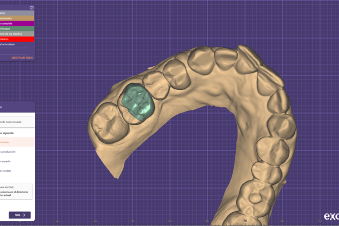 Onlay, Inlay, Overlay - CadCam Masters