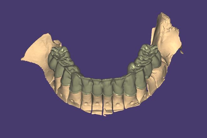 Cutback bridges and crowns - CadCam Masters