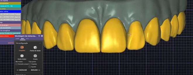 crowns and bridge anterior and posterior crown over abutments - CadCam ...