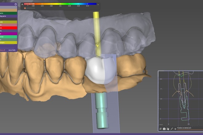 Implant Crown and Bridge - CadCam Masters