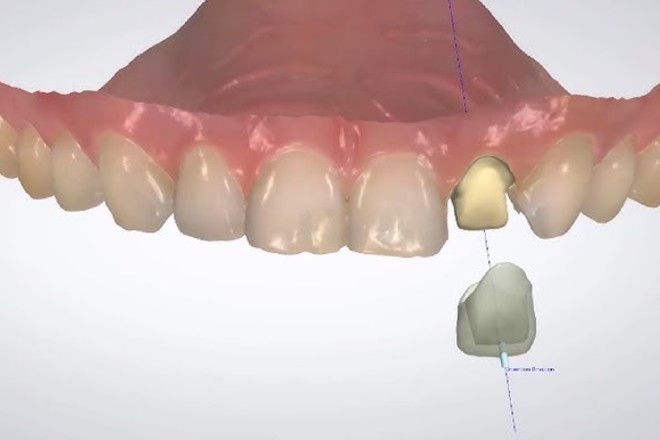anterior single unit crown - CadCam Masters