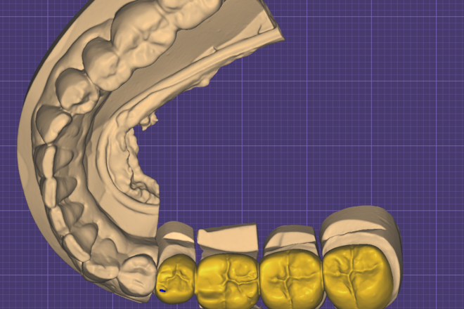 Single crowns&bridges - CadCam Masters