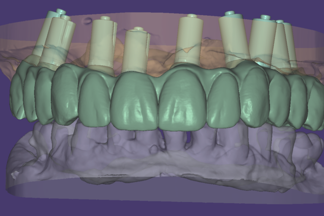 AllonX temporary designs - CadCam Masters