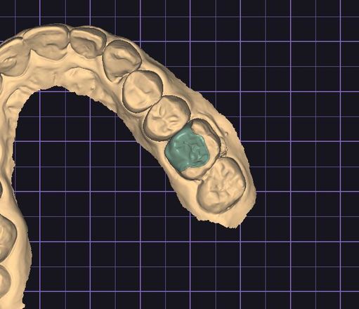 "Durable, Aesthetic Onlays & Inlays for a Seamless Smile - CadCam Masters