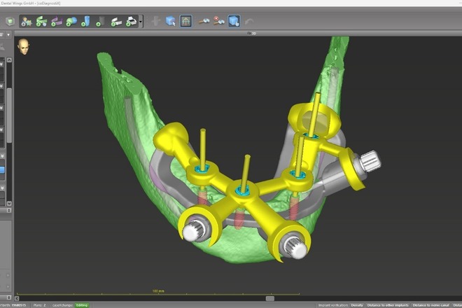 Stackable guide for implant planning - CadCam Masters